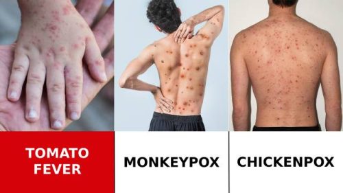 What is Tomato Fever? What are its Signs and halt?| touchheights